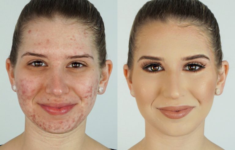 How To Correct And Conceal Acne With Makeup – Pepe's How Tos
